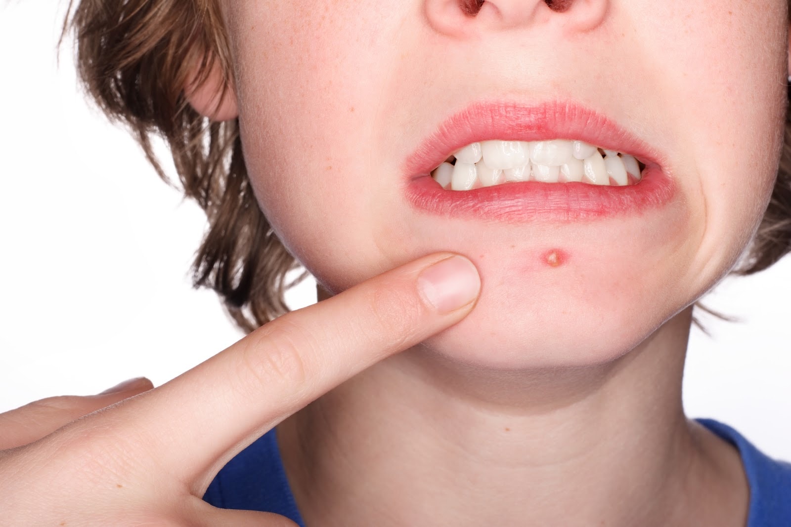10+ Surprising Myths About Acne That Need To Get Cleared Up - Zit ...